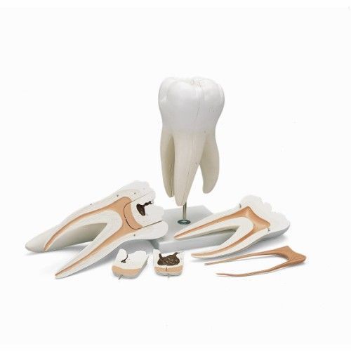 Enlarged Molar model with Dental Cavities D15 for £165.59